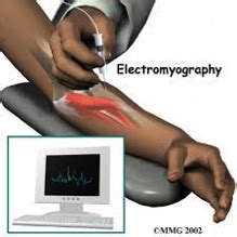 Electromyography Carolina Hand And Sports Medicine