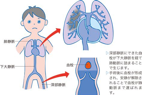 肺血栓塞栓症PTE 看護roo カンゴルー