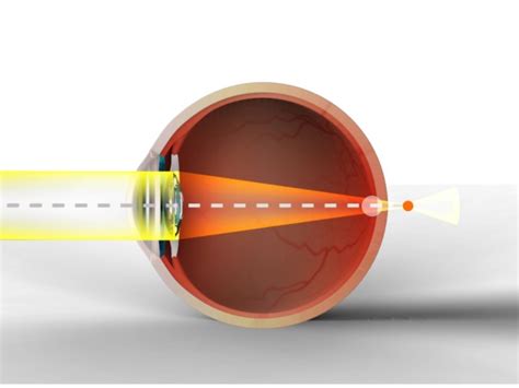 Improving Your Visual Acuity Understanding And Correcting Nearsightedness Farsightedness