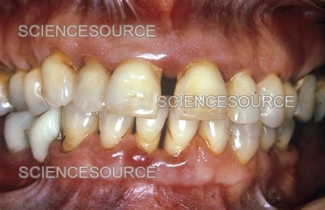 Severe Gum Disease Stock Image Science Source Images