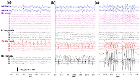 Figure 2 From Magnetoencephalographic Detection Of Synchronized