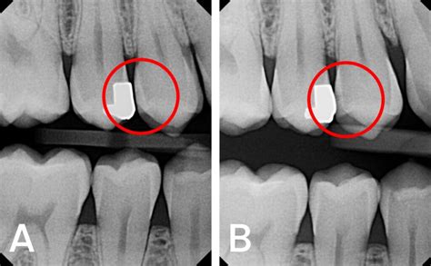 Interproximal Initial Carious Lesion Adjacent To A Restored Tooth Vvardis Professional Us