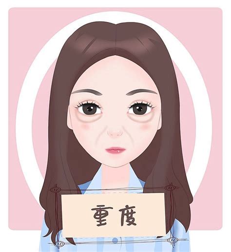 泪沟 眼部综合 泪沟程度 眼部 泪沟类型 眼袋 熬夜 填充泪沟 去眼袋 泪沟抚平眶隔脂肪释放 面部填充 填充泪沟 胶原蛋白泪沟 玻尿酸丰泪沟 嗨体去泪沟 自体脂肪填充泪沟 脂肪填充泪沟 玻尿酸