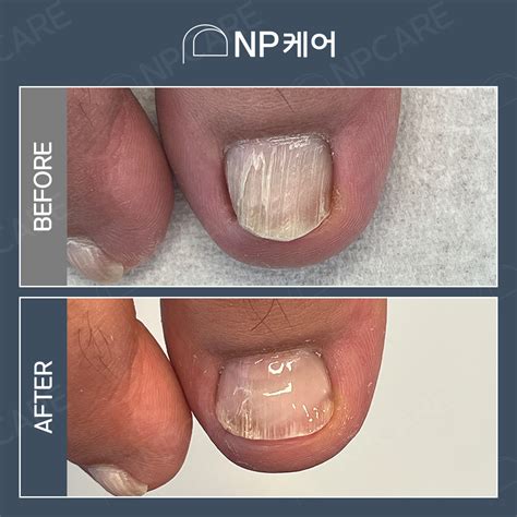 창원 진해 문제성발톱 창원 진해 내성발톱and발톱무좀 당신의 편안한 일상 Always Np케어 ⚠ 무료상담and예약문의 ⚠ Tel 010 5014 8125 🚕 창원시