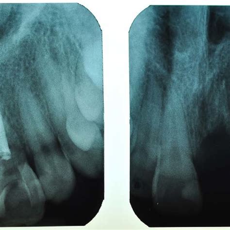 Pdf Ankylosed Permanent Teeth Incidence Etiology And Guidelines For