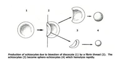 Hematology Extrinsic Defects Leading To Erythrocyte Destruction Flashcards Quizlet