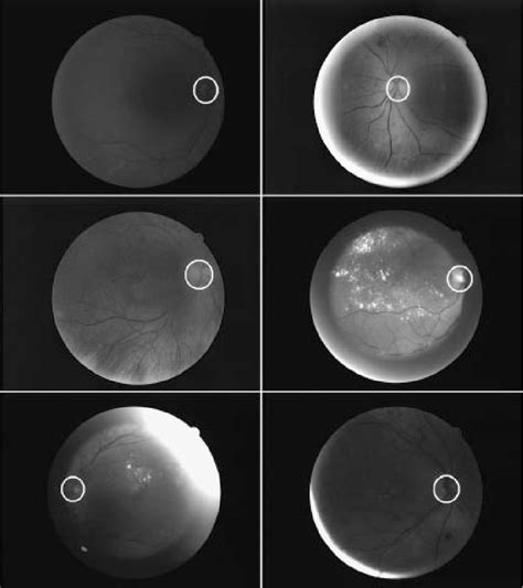 Figure 5 From Fast And Robust Optic Disc Detection Using Pyramidal Decomposition And Hausdorff