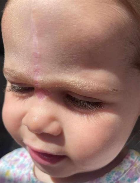 Adorable Beauty The Mother Of A Girl With A Birthmark Showed Off Her Daughter After Surgery
