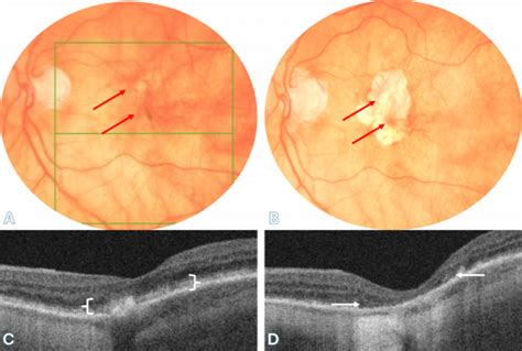 Choroidal Vascular Anomalies Posterior Vortex Veins Choroidal