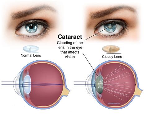 Cataracts Faqs — Michele Lee Md