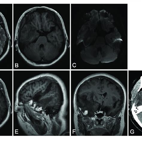 A Axial T2 Weighted Imaging Showed Multiple Heterogeneous Download Scientific Diagram