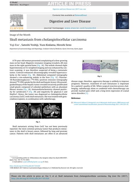 Pdf Skull Metastasis From Cholangiolocellular Carcinoma