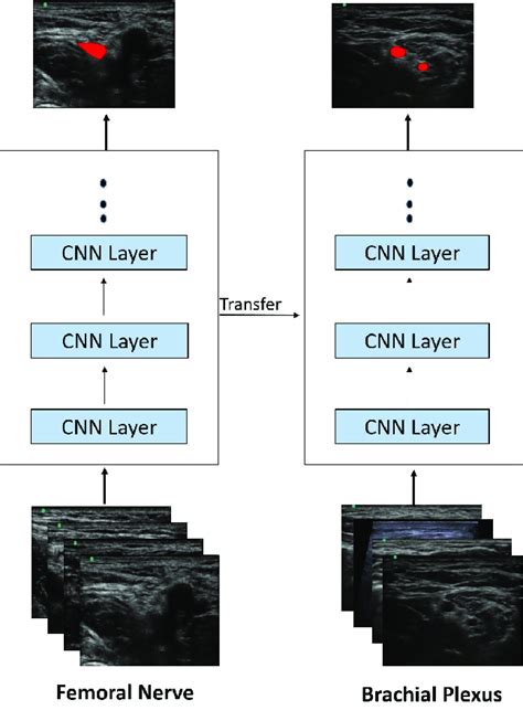 workflow of brachial plexus identification using transfer learning