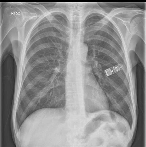Medtronic Loop Recorder Manual