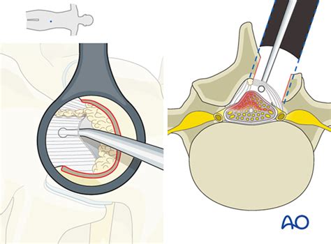 Laminectomy Decompression