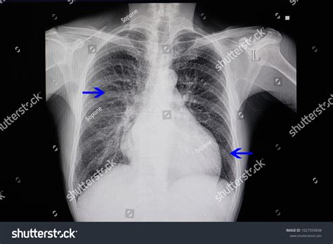 Enlarged Heart X Ray