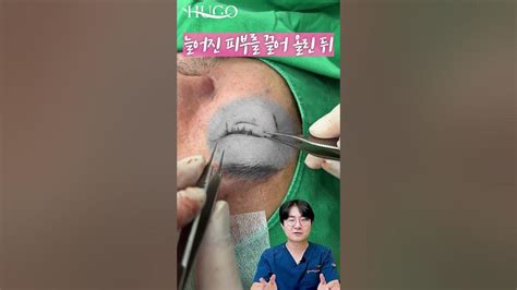 눈밑주름과 인디언주름 한번에 제거 하안검 하안검수술 눈밑지방재배치 인디언밴드 인디언주름 눈밑주름 눈밑처짐 눈밑처짐 인디언주름 눈밑지방 눈밑지방재배치