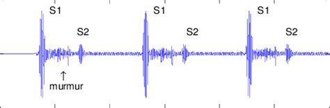 Pcg Signal For The Normal Above And Abnormal Heart Sounds With Early Download Scientific