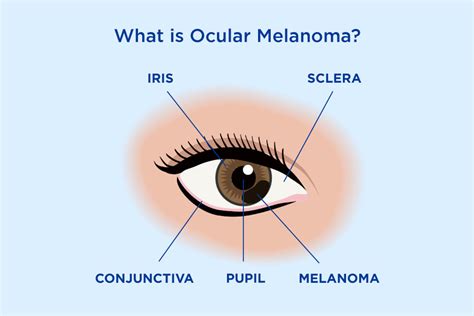 Ocular Melanoma Keep An Eye On Common Risk Factors For Ocular Melanoma
