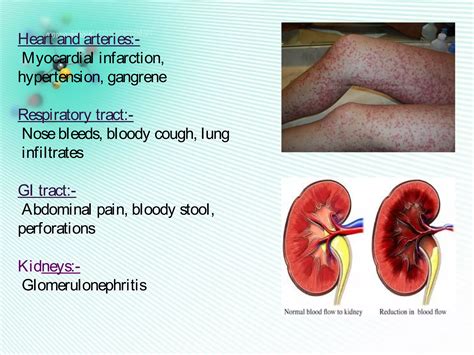 Auto Immune Vasculopathy And Scleroderma Ayurvedic Perspective Ppt