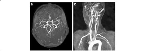 Mr Angiography Of A Cerebral Arteries Showing A Missing Left