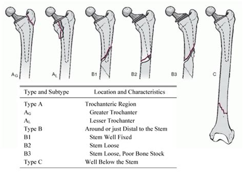 Periprosthetic Hip Fracture Mtwortho