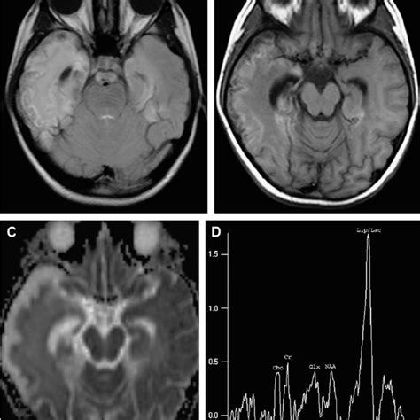 Cmv Associated Polyradiculopathy Sagittal A And Axial B