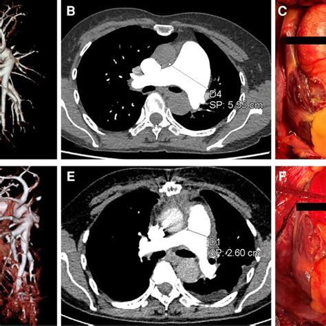 Preoperative And Postoperative Data Ab Are Preoperative Pulmonary