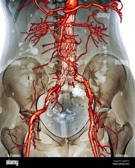 Stent In Aortic Aneurysm 3d Computed Tomography Ct Angiogram Of The Abdomen And Pelvic Region