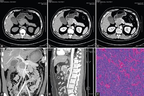 Pancreatic Primitive Neuroectodermal Tumor Focus On Radiolo Journal Of Cancer Research And