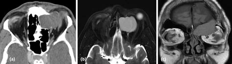An A Axial View Ct Scan Showing A Left Frontoethmoidal Mucocele Download Scientific Diagram