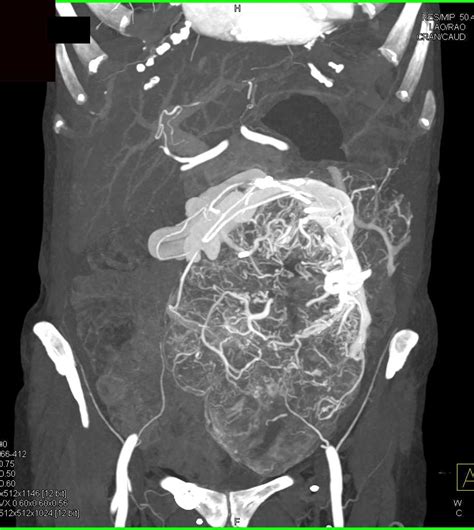 Large Gist Tumor With Neovascularity Gastrointestinal Radiology Case