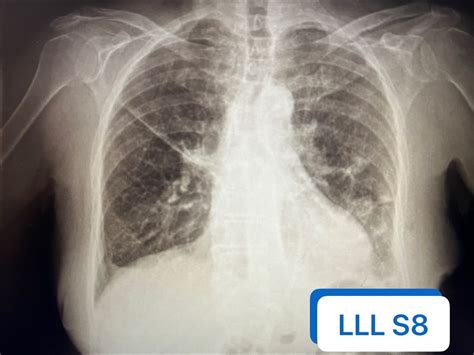 Carlos Galvez On Linkedin Complex Segmentectomies Are Not Only Defined As Those With Two Or More…