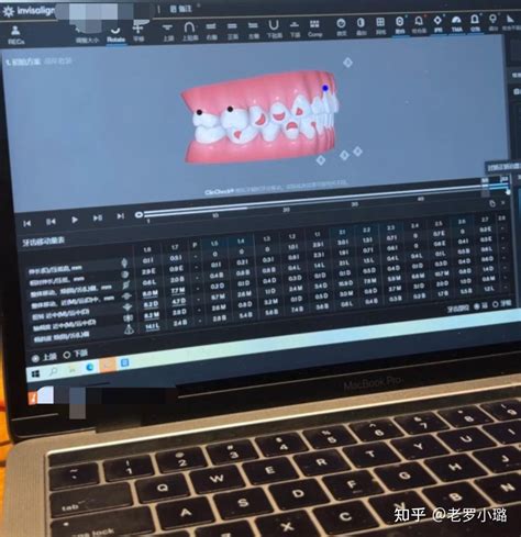 福斯曼正畸记录一戴牙套前 知乎