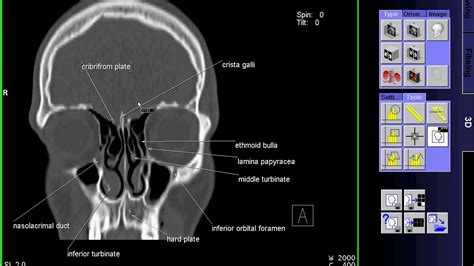 Ct Anatomy Of Nose At Seth Treadwell Blog