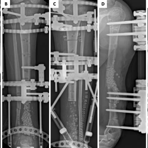 Distal Tibia Osteomyelitis In Patient 1 A C Ap Radiographs Of The Download Scientific Diagram