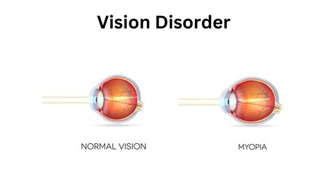 What Is Nearsightedness Myopia