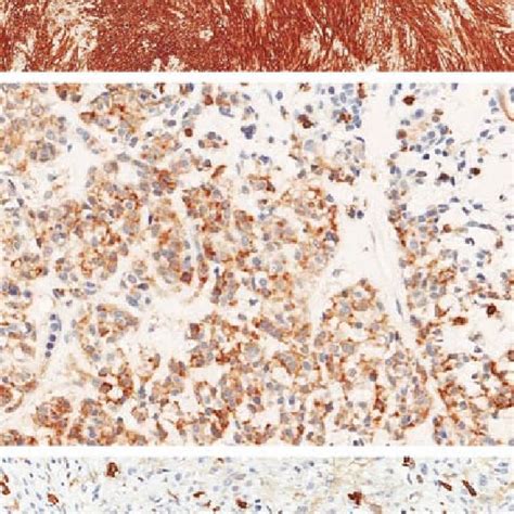 Ihc Staining With Cd117 C Kit Different Stainng Patterns Download