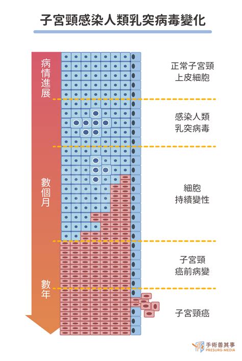 子宮頸癌與hpv有關？子宮頸癌症狀、原因、前兆、治療方式