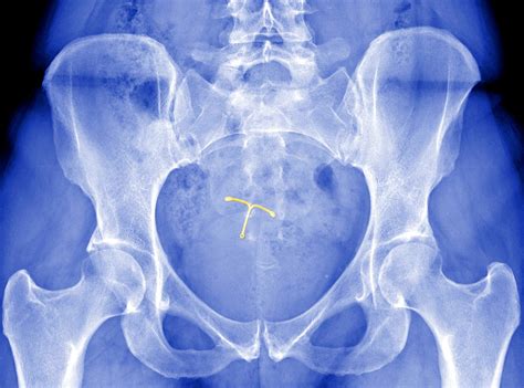 Iud Complications Obgyns Discuss Expulsion And Perforation Self