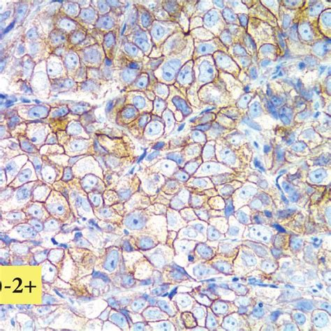 B Different Staining Patterns Seen In Her2 Testing By Immunohisto