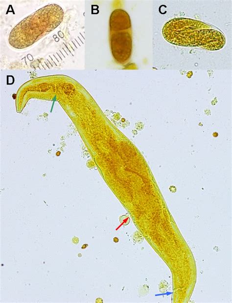 First Human Case Of Fatal Halicephalobus Gingivalis Meningoencephalitis In Australia Pmc