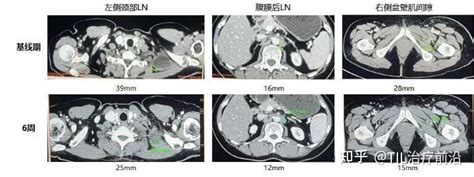 肺癌、卵巢癌、宫颈癌、肝癌等实体瘤患者的新希望！两款til细胞疗法即将上市 知乎