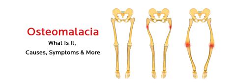 Osteomalacia Nhs Osteomalacia Causes And Treatment 1st Wave