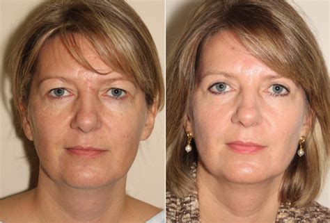How To Choose The Right Blepharoplasty Surgeon In Vancouver