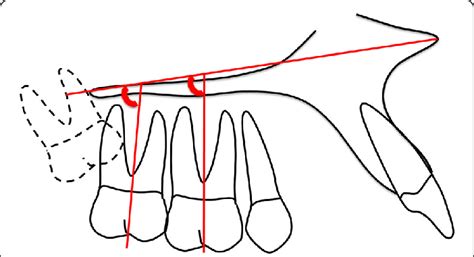 Evaluation Of Molar Sagittal Angulations Download Scientific Diagram