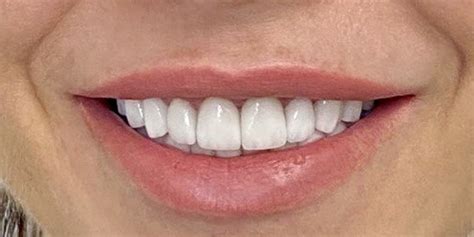 Bruxism Treatment And Bite Correction Before And After Case 2909