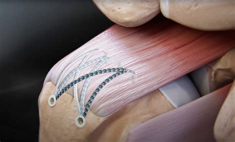 Rotator Cuff Tear Repair Duncan Tennent