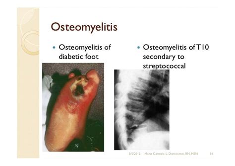Bone And Joint Infections Osteomyelitis Septic Arthritis