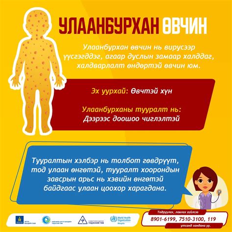 Нийгмийн эрүүл мэндийн үндэсний төв Улаанбурхан өвчин нь халдварлалт